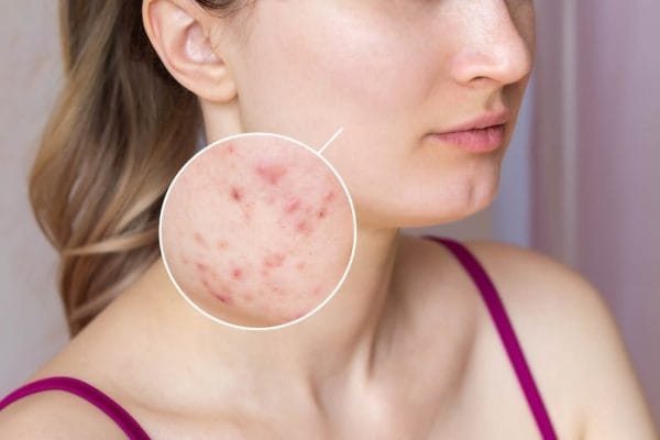 Ketahui Cara Menjaga pH Kulit agar Seimbang & Sehat Berikut Ini!
